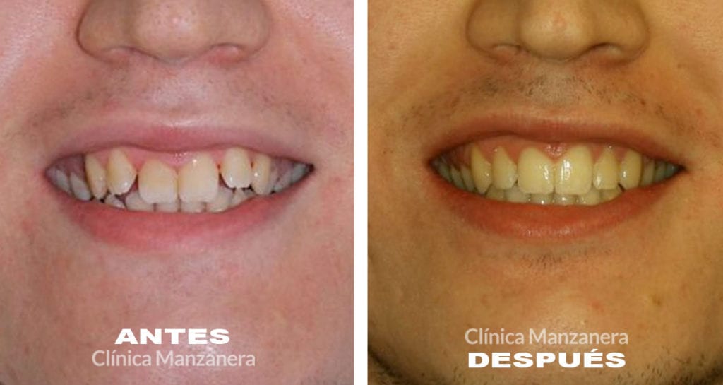 Joven con sobremordida aumentada y mordida cruzada tratado con ...