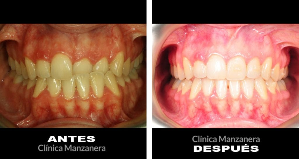 Adulto con mordida borde a borde tratado con ortodoncia lingual - Caso ...