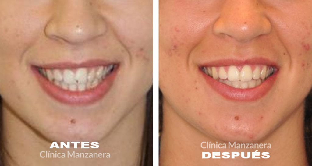 Sonrisa Invertida: Mujer adulta con mordida cruzada tratada con Invisalign