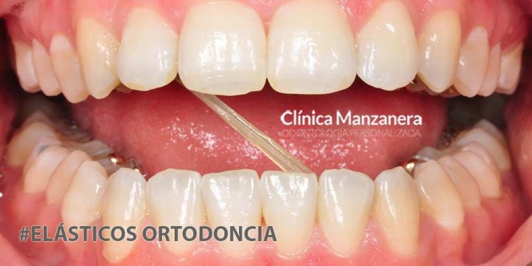 Levantes de mordida o Topes Ortodoncia: Dr. David Manzanera