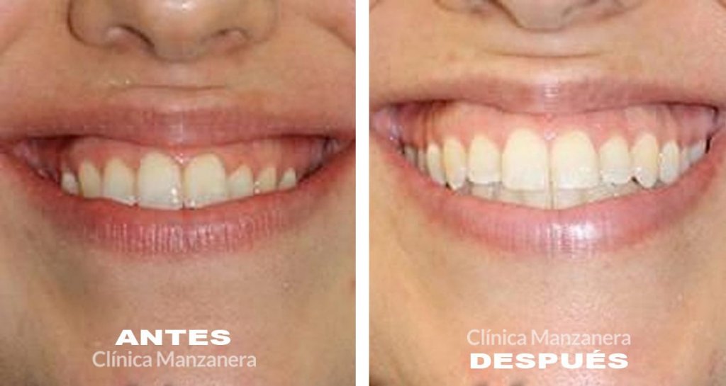 Mordida cruzada anterior y desviación línea media - Caso 29 - Clínica ...