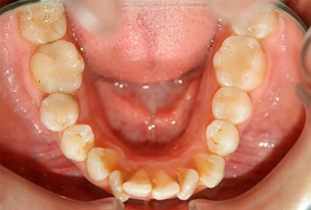 ¿Es necesario quitar las Muelas del Juicio para poner brackets?