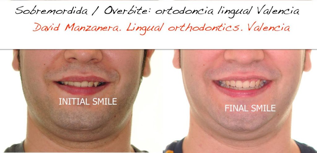¿Qué es la sobremordida y cómo solucionarla? - Clínica Manzanera