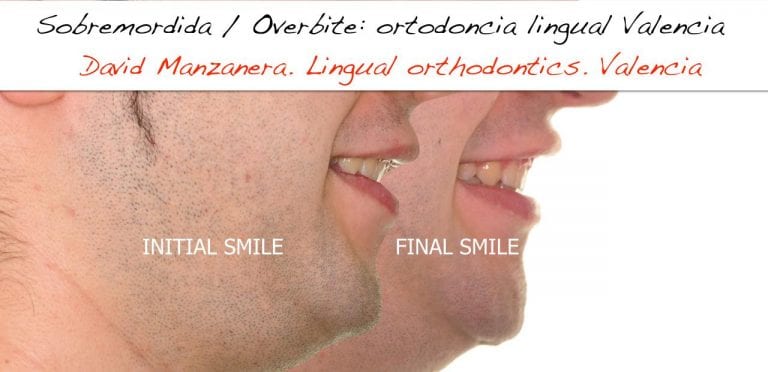 ¿Qué es la sobremordida y cómo solucionarla? - Clínica Manzanera