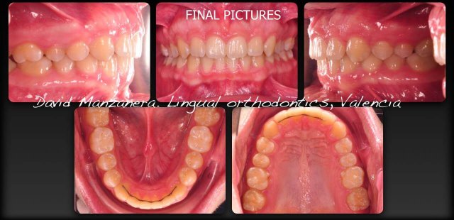 ¿Qué es la sobremordida y cómo solucionarla? - Clínica Manzanera