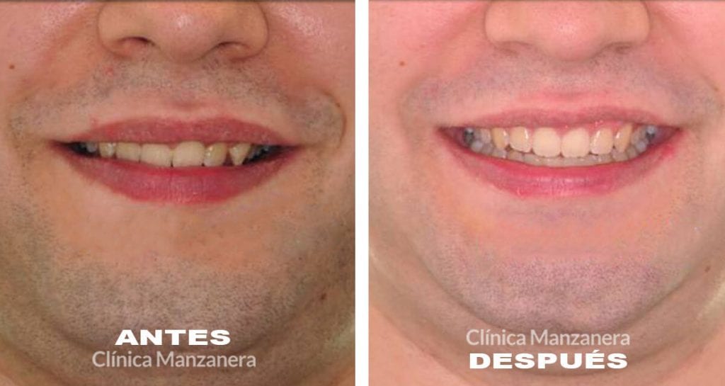 ¿Qué es la sobremordida y cómo solucionarla? - Clínica Manzanera