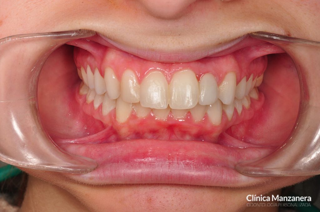 Agenesia Dental: Tipos, Causas y Tratamientos - Clínica Manzanera
