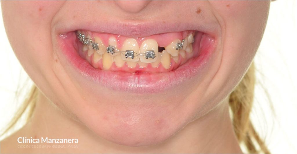 Agenesia Dental: Tipos, Causas y Tratamientos - Clínica Manzanera