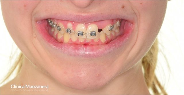 Agenesia Dental: Tipos, Causas y Tratamientos - Clínica Manzanera