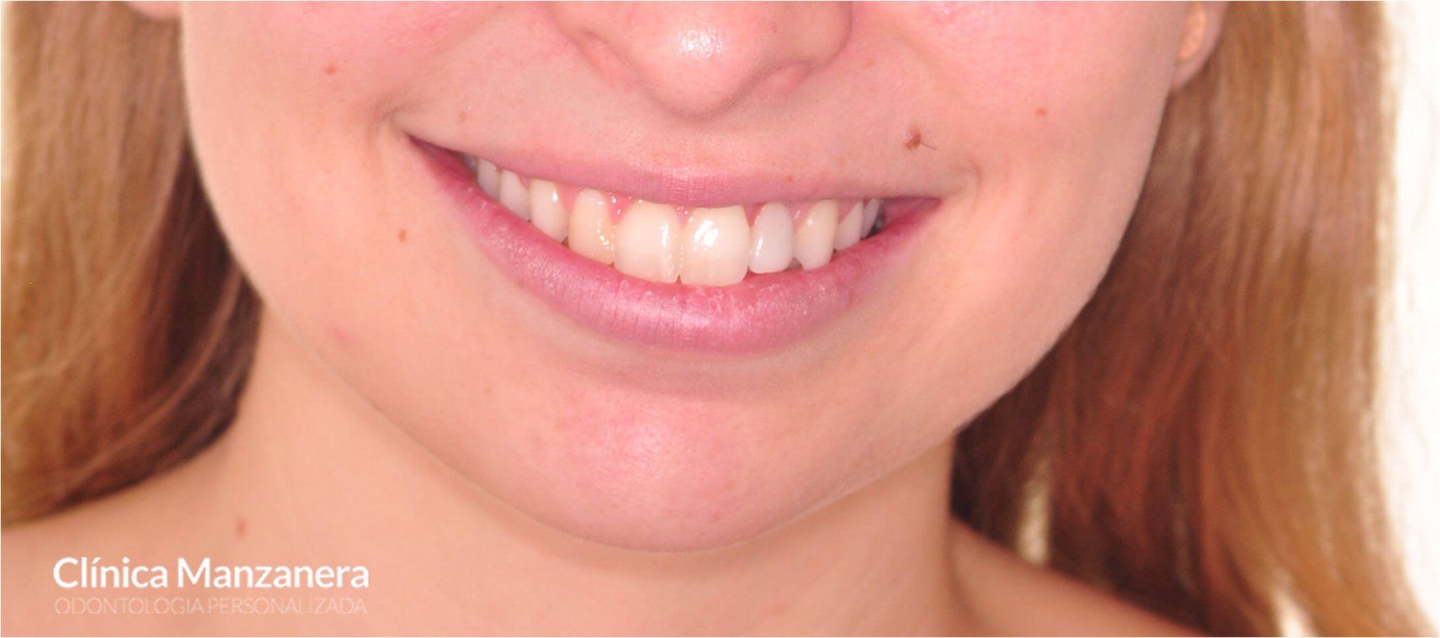 Agenesia Dental: Tipos, Causas y Tratamientos - Clínica Manzanera