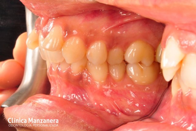Clase II división segunda tratado con Ortodoncia Invisible - Clínica ...