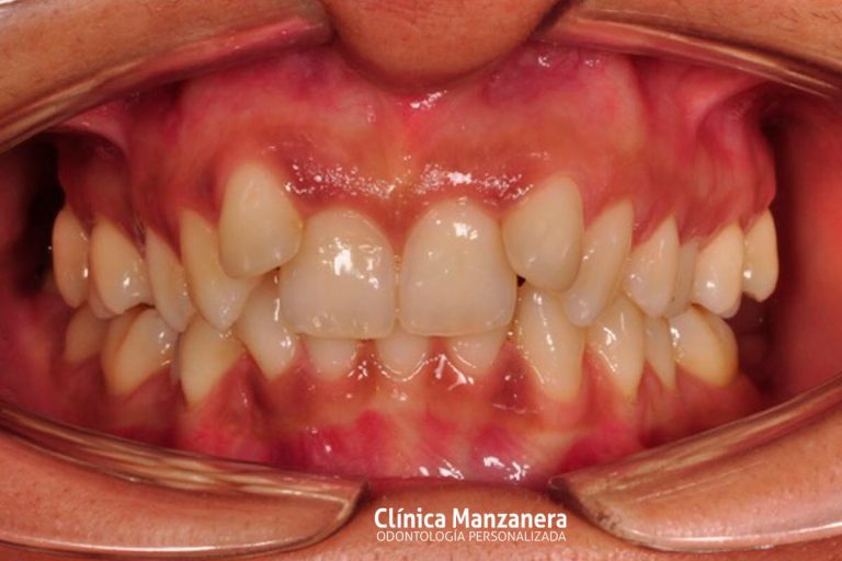 Clase II división segunda tratado con Ortodoncia Invisible - Clínica ...