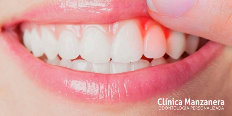 Encías inflamadas: Causas y Soluciones - Clínica Manzanera
