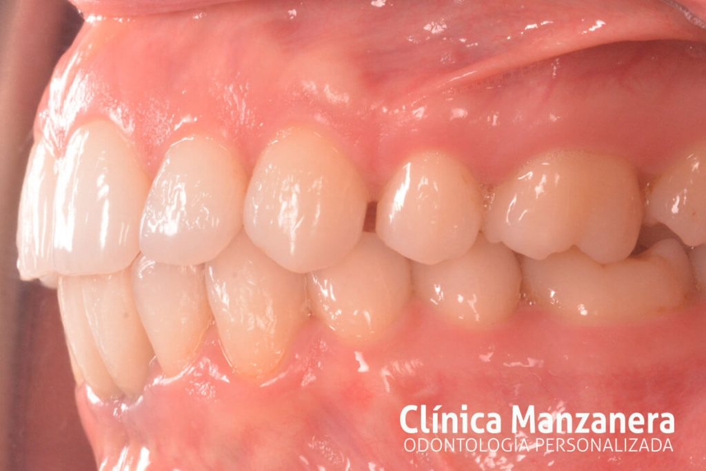 Desviación línea media superior tratado con implantes y ortodoncia ...