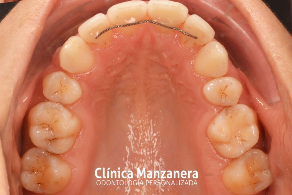 Desviación línea media superior tratado con implantes y ortodoncia ...
