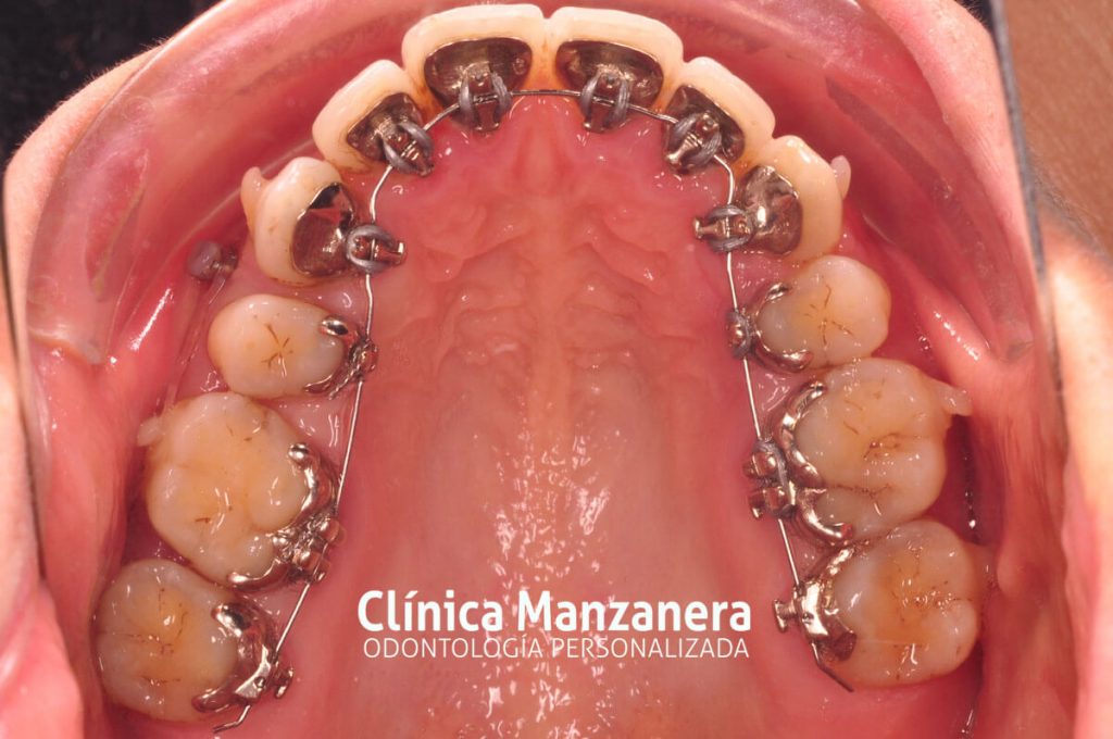 Desviación línea media superior tratado con implantes y ortodoncia ...