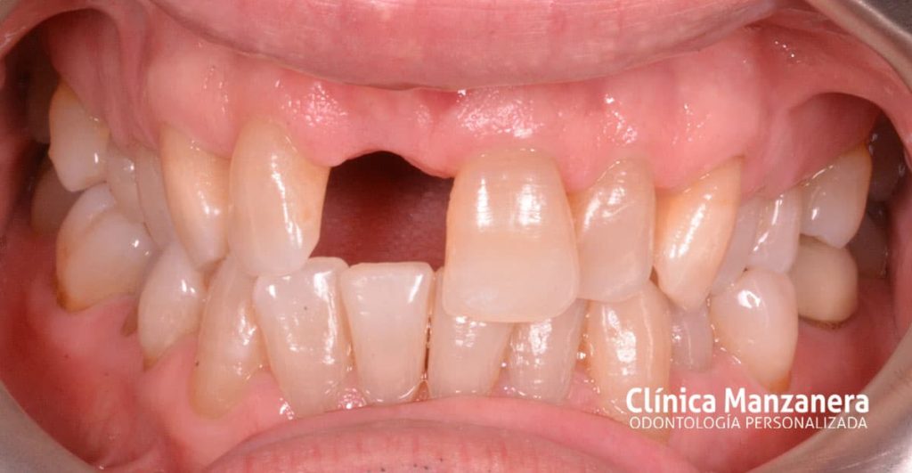 Pérdida de diente por Traumatismo Dental resuelto con Implantes