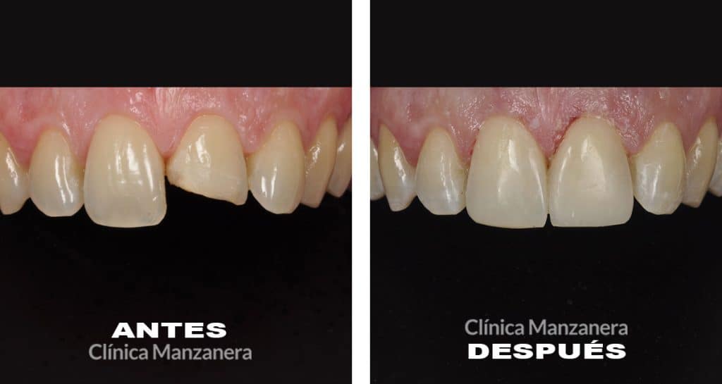 Reconstrucción estética del borde incisal desgastado - Caso 67 ...