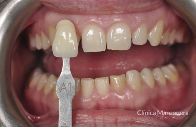 Reconstrucción bordes incisales, carillas y blanqueamiento dental ...