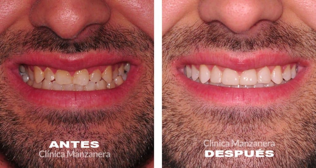 Antes Y Despues Ortodoncia