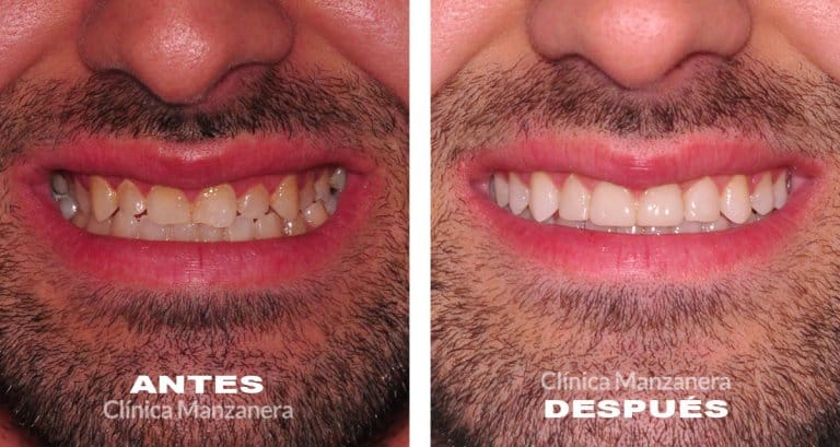 Caso de ortodoncia Invisible y reconstrucción dental con composites ...