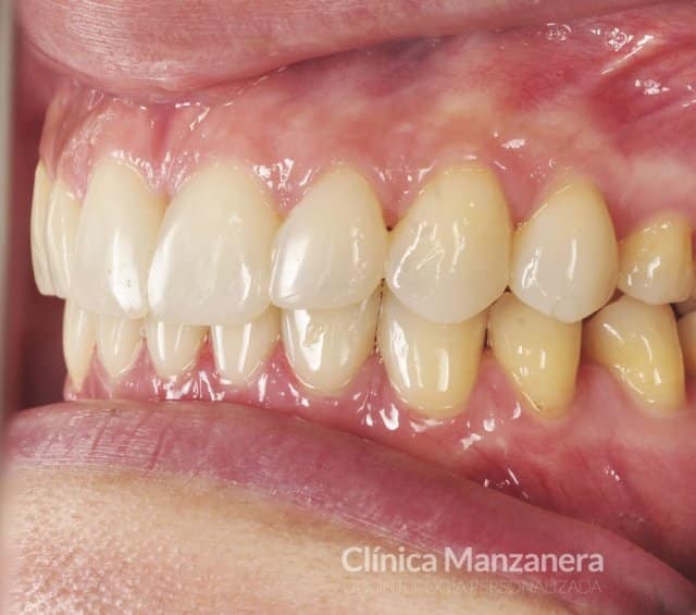 Antes y después Arcadas Comprimidas con Ortodoncia Invisible - Clínica ...